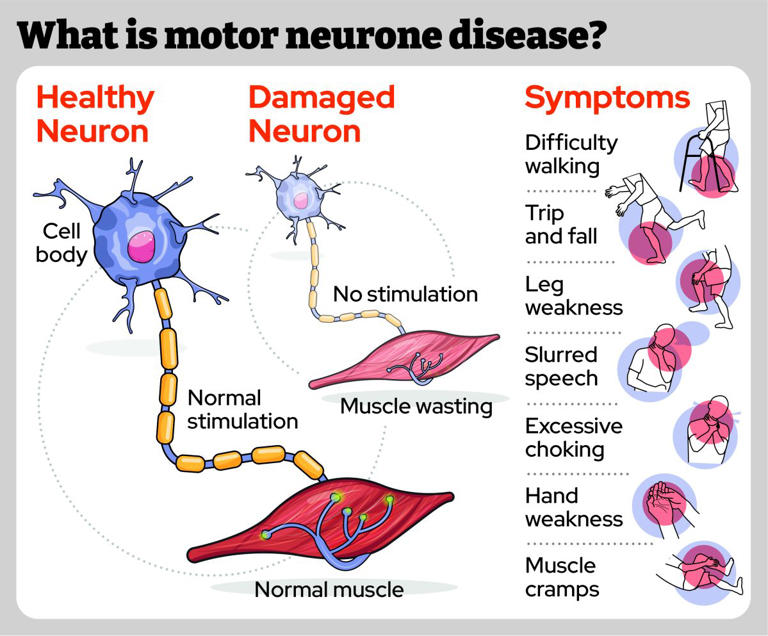 What is MND – and are sportspeople more likely to get it?