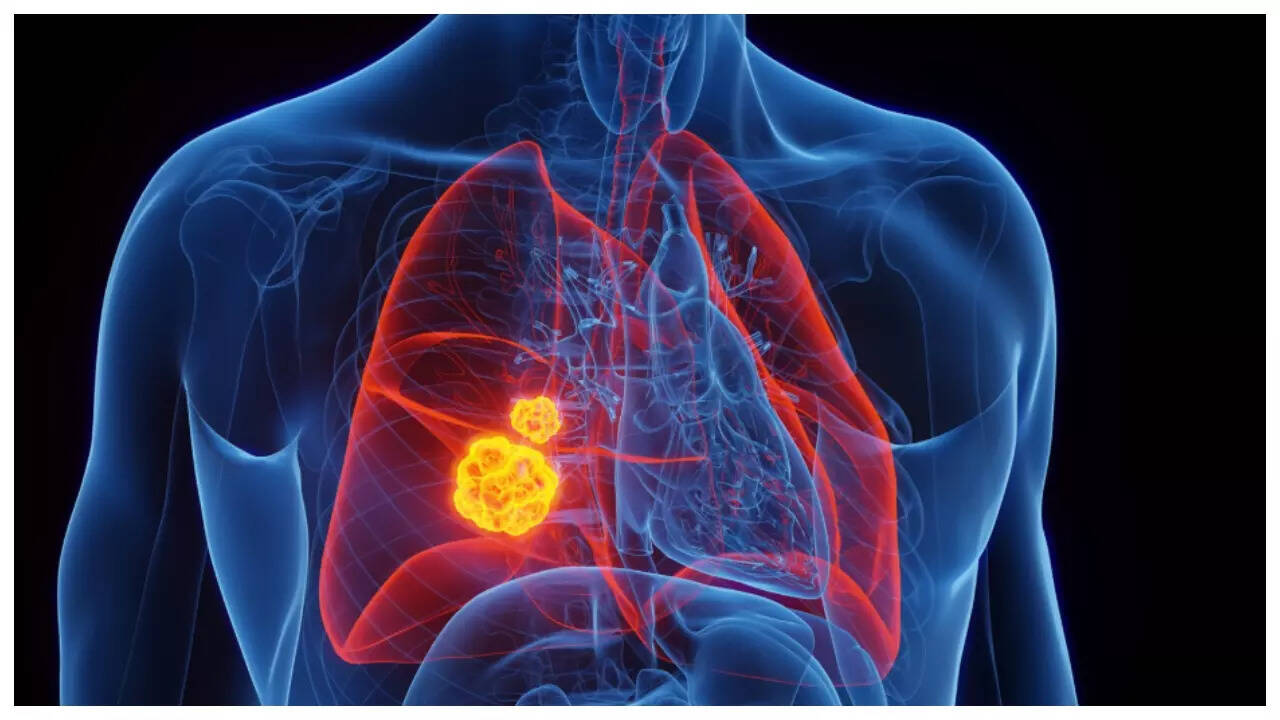 5 Lung Cancer symptoms that often go unnoticed. 'Feels like a common...'