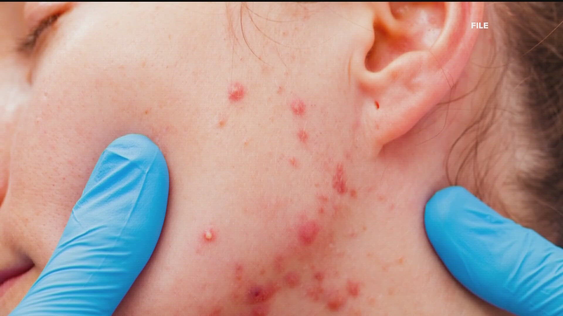 3 people in Georgia infected with measles