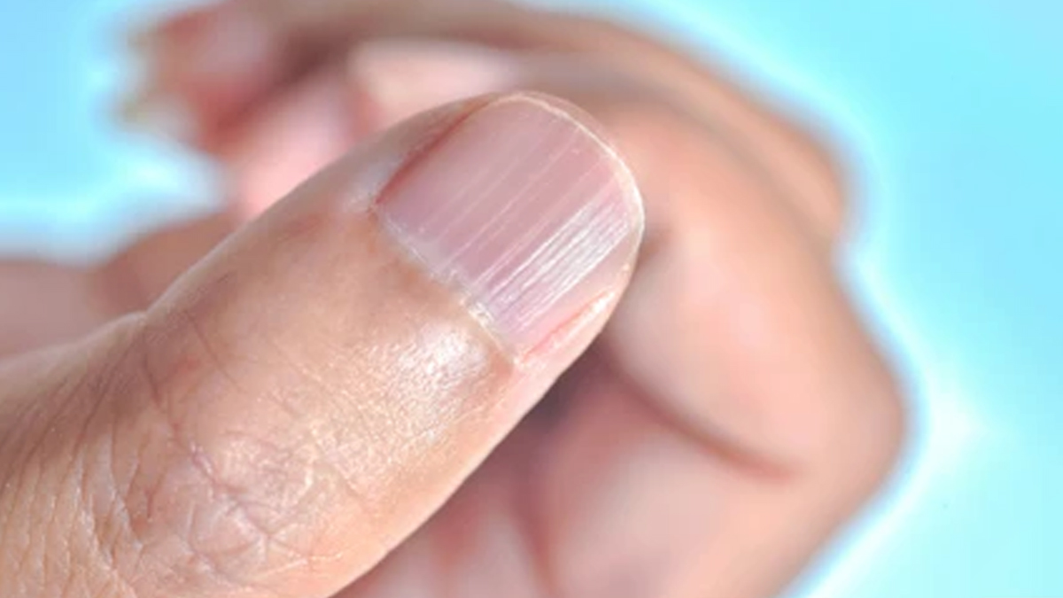 Nail Ridges During Pregnancy: Expert Answers If It's a Concern After ...