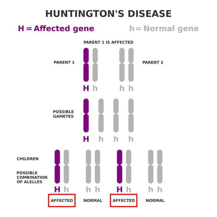 Huntington’s disease successfully treated in 1st major breakthrough