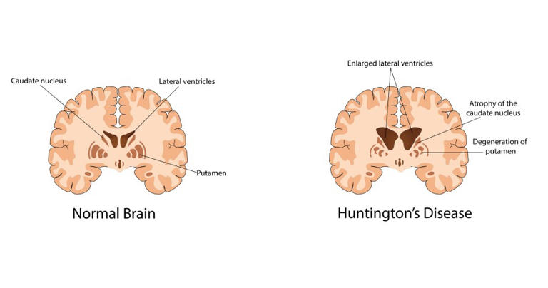 Huntington’s disease successfully treated in 1st major breakthrough