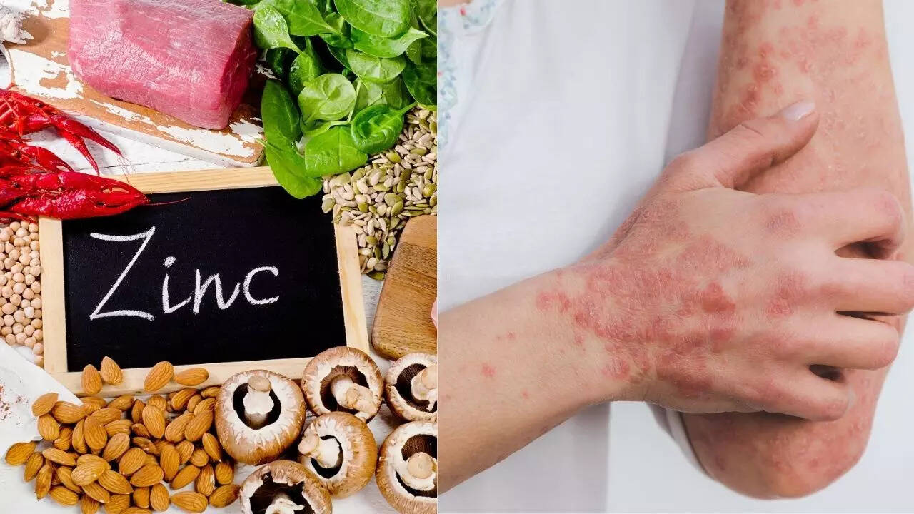 Zinc deficiency symptoms that show up on the skin: Causes and remedies