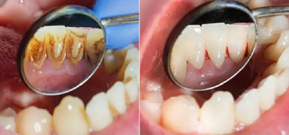 How to cure dental pyorrhea? Dr. Deepak Kumar reveals an effective home ...