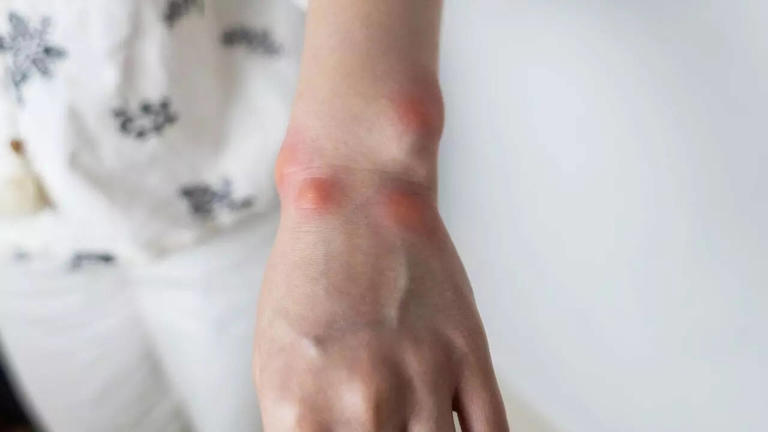 5 home remedies for bee stings that actually work