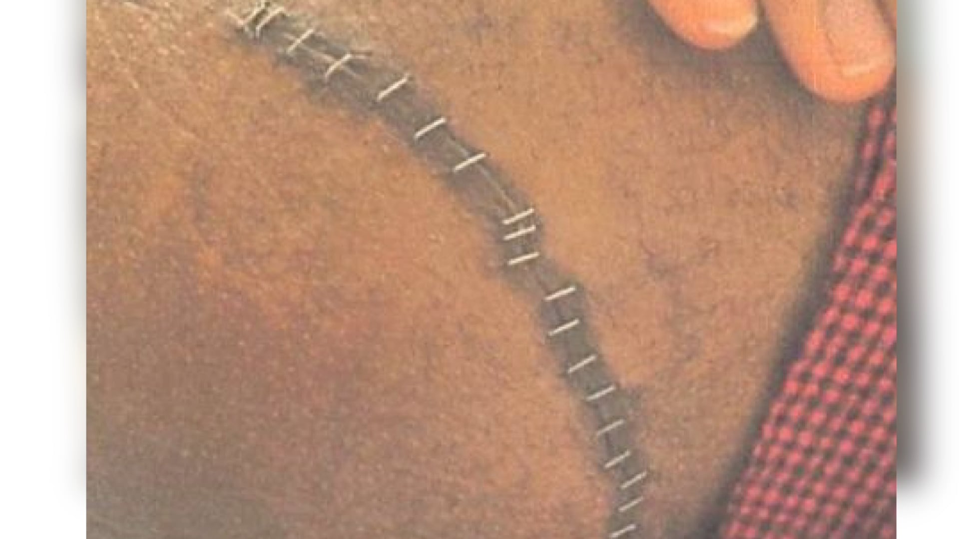 Photos Federal Lawsuit Filed Against Usm Omega Psi Phi Shows Injuries