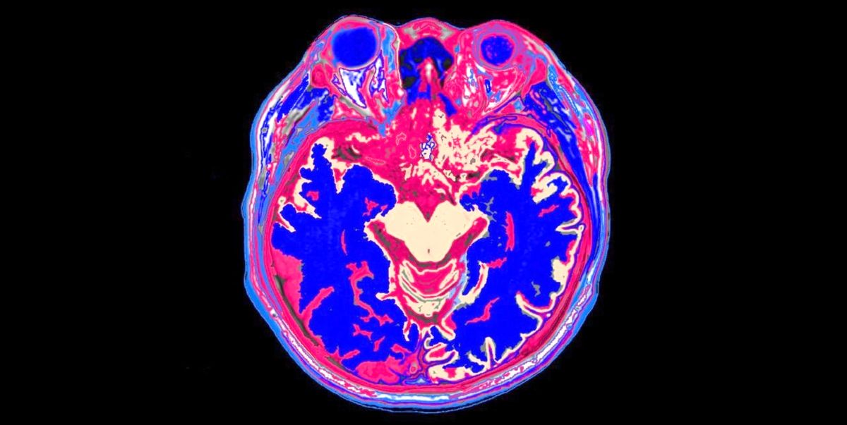 Scientists Think They Could Soon Heal Brain Damage from a Stroke