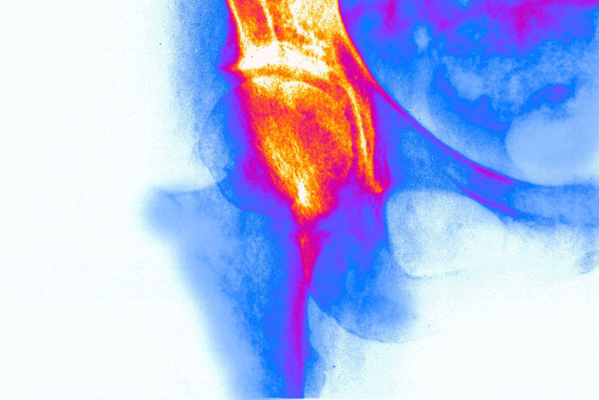 Osteoporosis: the silent disease