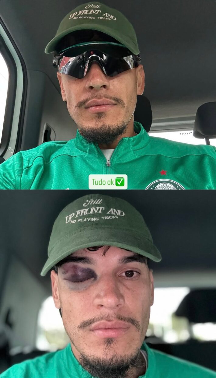 Gustavo Gómez posta foto com olho roxo após jogo com o River Plate ...