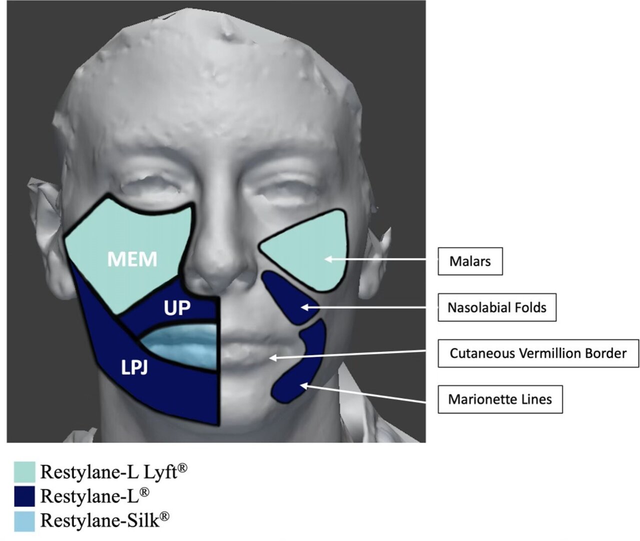 Volumetric study shows objective effects of hyaluronic acid filler ...