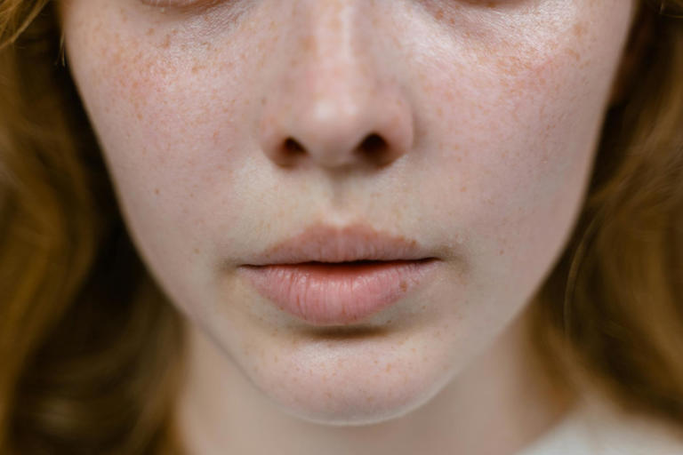 The Great Pore Debate: Sebaceous Filaments vs. Blackheads
