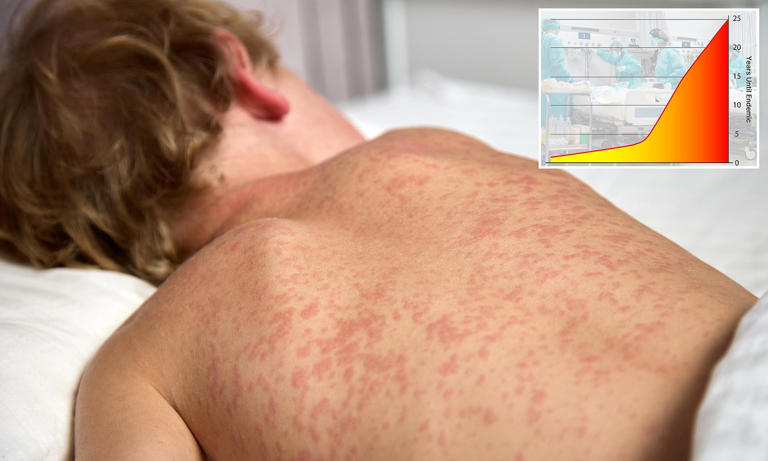 Officials race against the clock to treat babies exposed to measles by ...