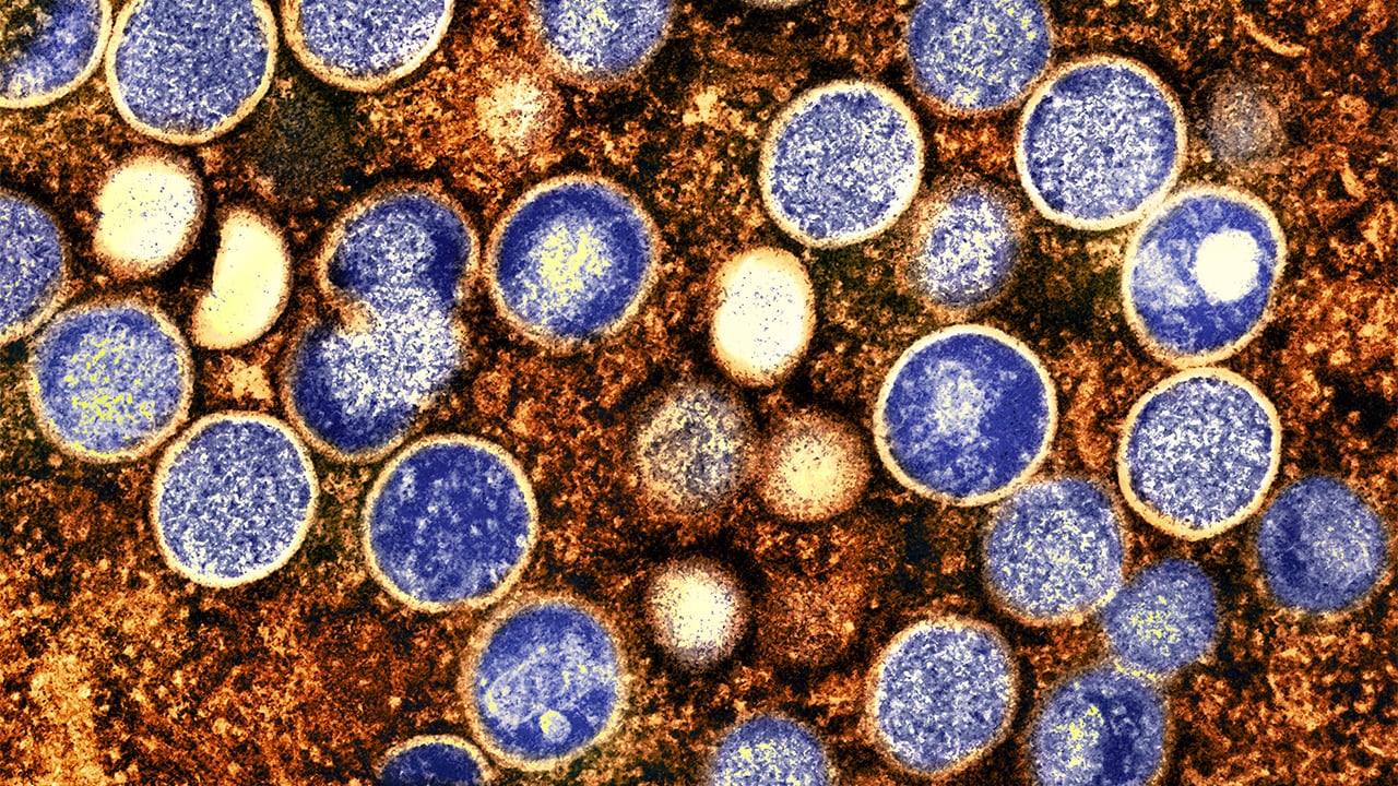 Monkeypox traces found in Pierce County wastewater, no active cases ...