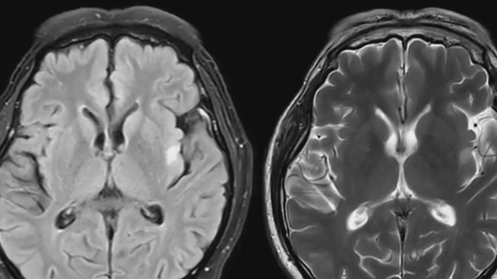 UCSF study on CTE seeks living athletes' data to help diagnose the ...