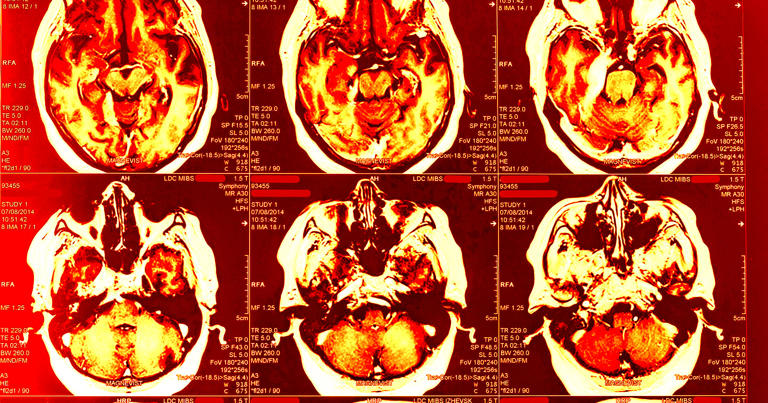 Medical Examiners Found Something Grim About the Brain of the Gunman ...