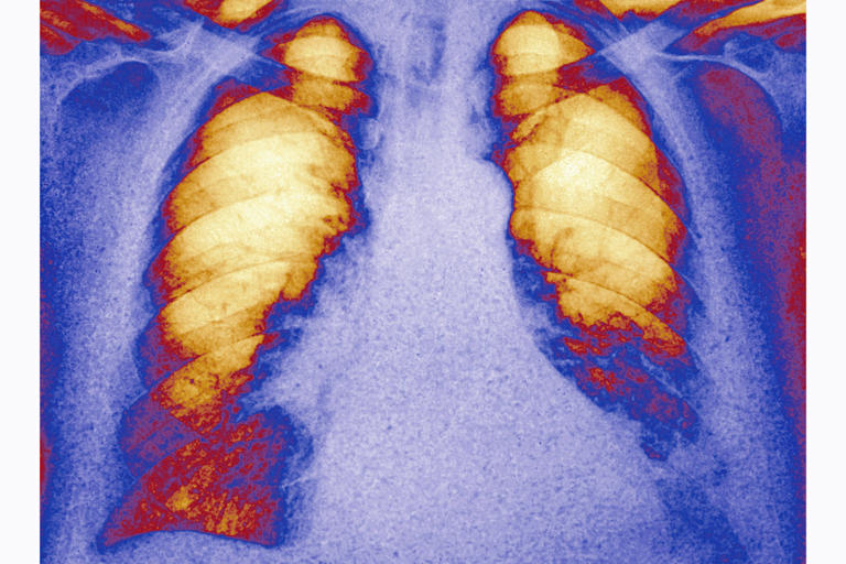 Recovery Is a Journey. Readers Share Their Advice After Blood Clots.