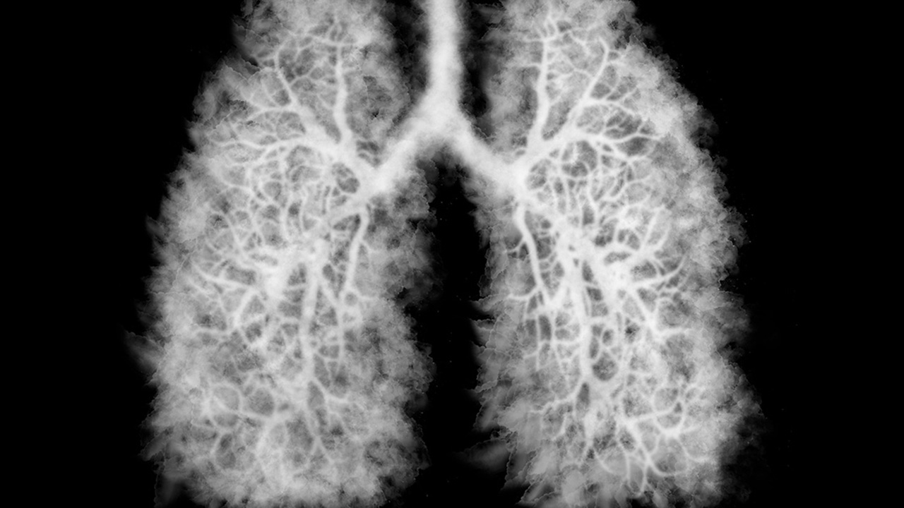 Caution Over Vaping After Teen Develops ‘Popcorn Lung' Linked to ...