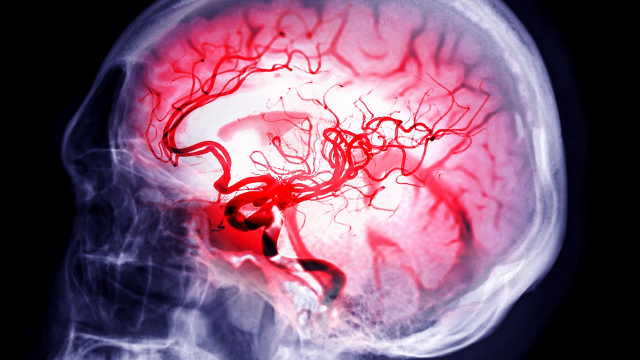 Early Warning Signs of an Aneurysm You Shouldn't Ignore