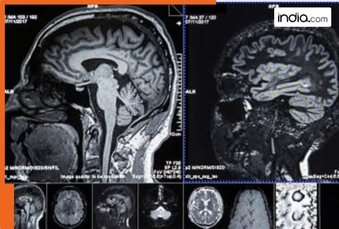 These rare brain disorders make you completely fearless; what are they ...
