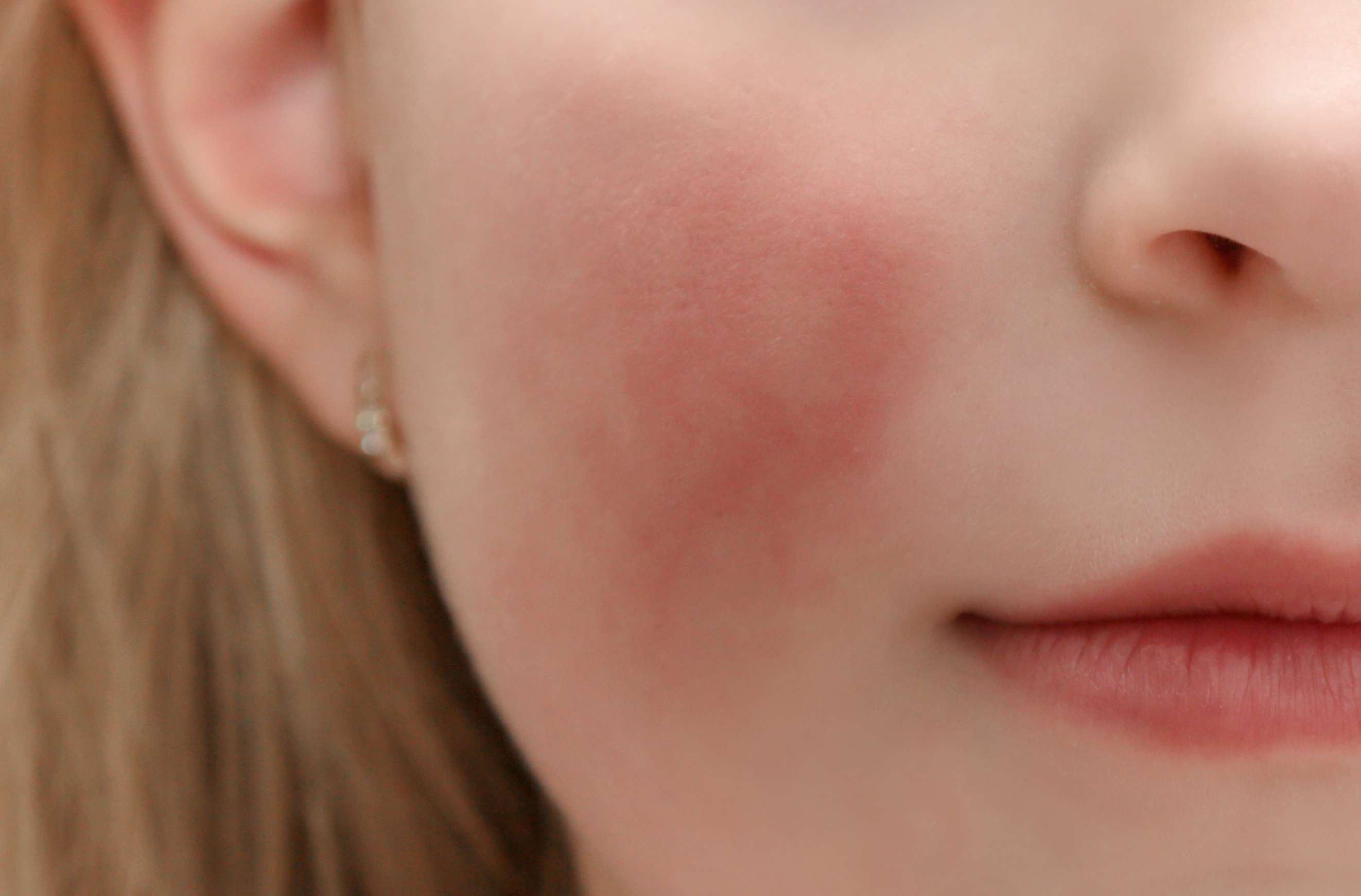 What to know about fifth disease ("slapped cheek" disease)