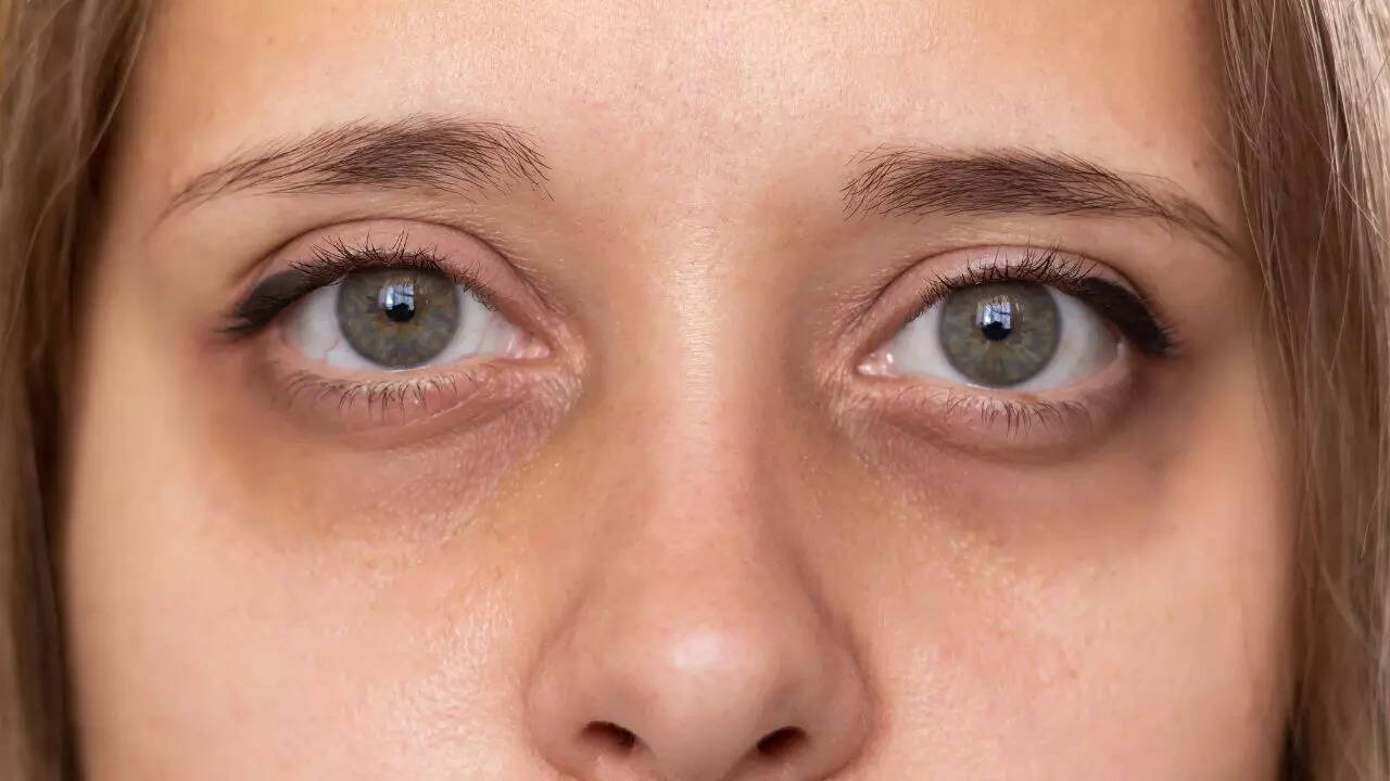 Dark circles under your eyes may reveal signs of kidney failure, liver ...