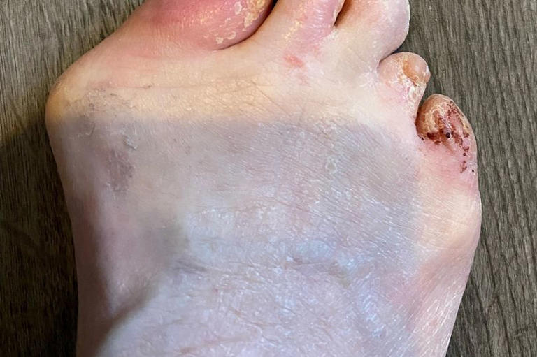 Woman's fingers and toes fell off after she was sent home from hospital