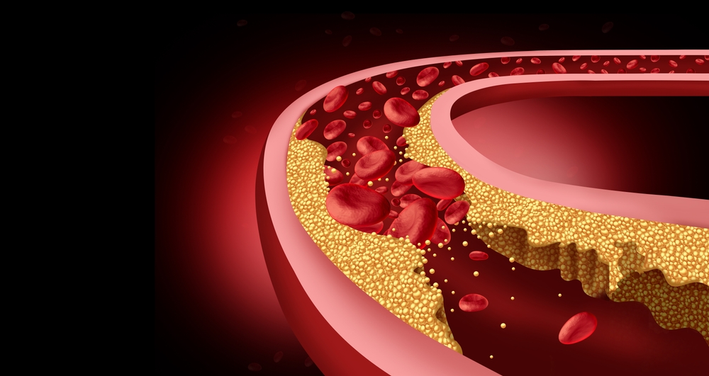 10 Subtle Symptoms of Clogged Arteries You Shouldn't Ignore