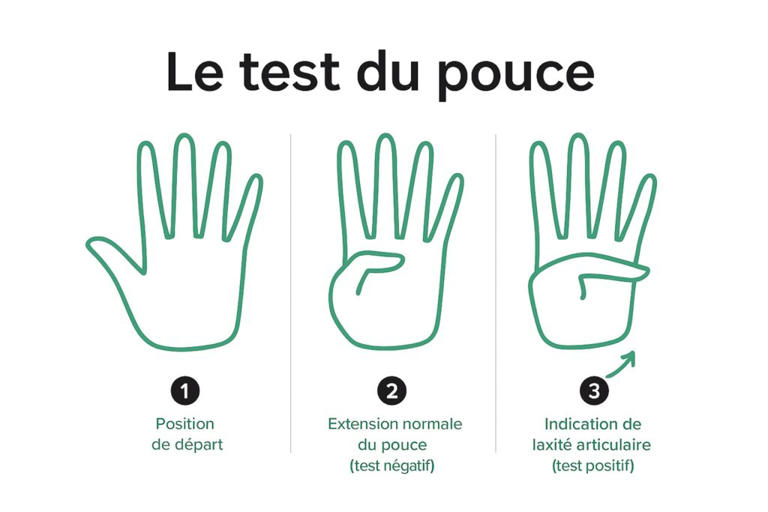 Anévrisme : le test du pouce peut révéler en 3 secondes si vous avez un ...