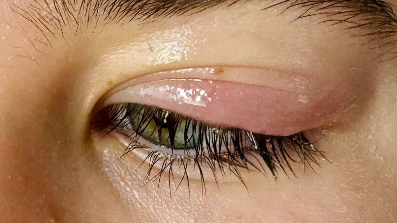 Eyelid problems and disorders explained: Causes, symptoms, and ...