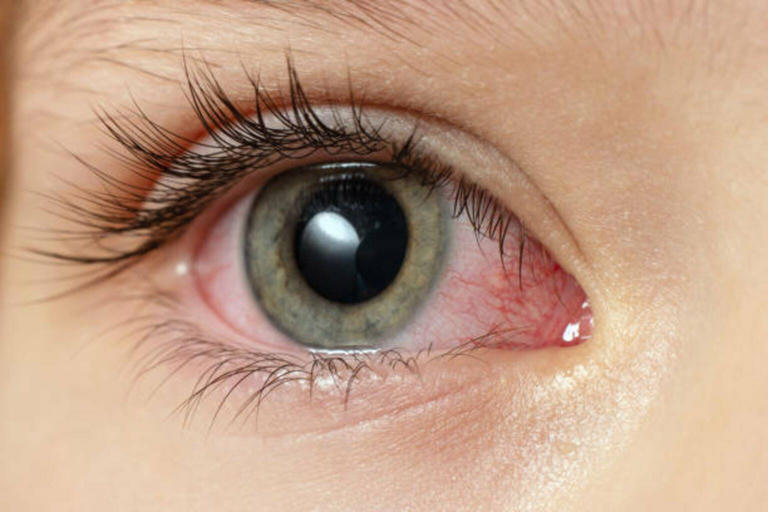 KALA BIO plunges 92% after phase 2 failure of eye condition drug