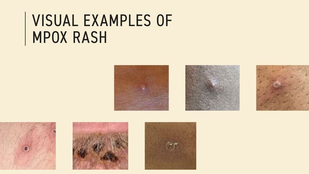 Mpox (monkeypox) virus discovered in Pierce County wastewater