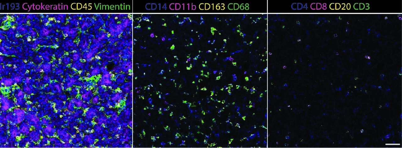 Myeloid immune cells may offer a new target for immunotherapy in liver ...