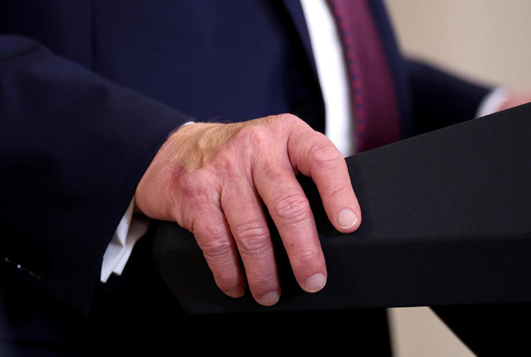 Trump, 79, Slathers Bruised Hand With Mismatched Makeup