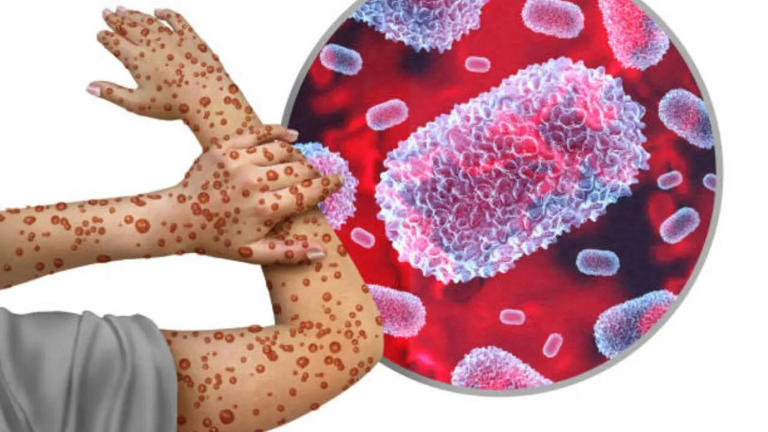 Beware of Bindi Leukoderma, As Adhesive Chemicals May Harm Your Skin