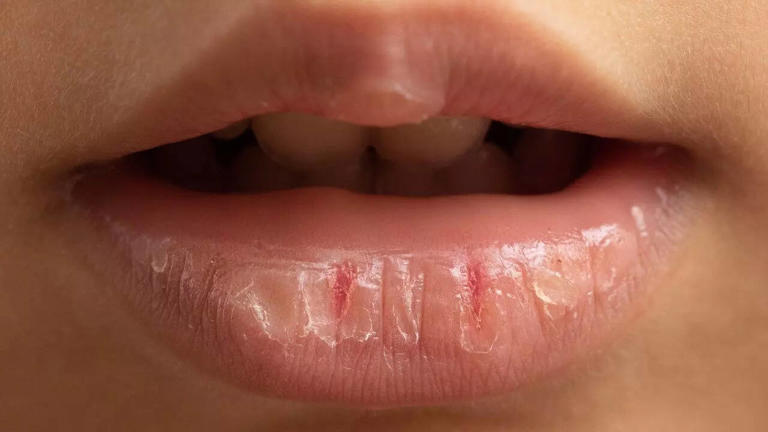 How to heal dry and chapped lips naturally: Signs, causes, and effective remedies