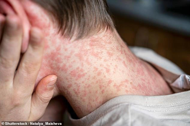Urgent warning issued for Aussies amid highly contagious virus outbreak