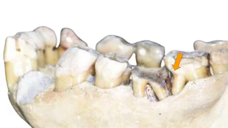 Those Marks On Ancient Teeth Might Not Be From Toothpicks After All