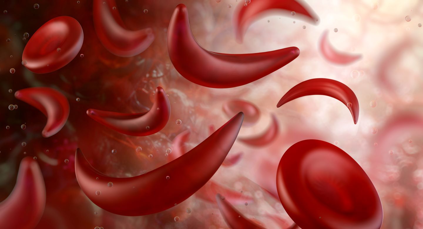 Sanius continues AI investment to advance platform for sickle cell patients