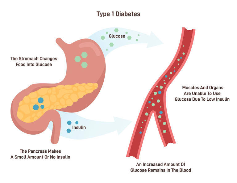 5 Essential Tips For Traveling Solo With Type 1 Diabetes