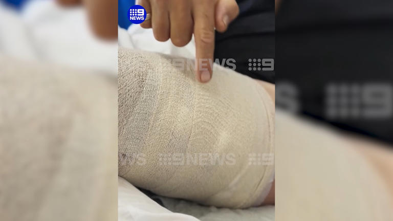 'Could be the end': Surfer who survived shark attack relives shocking ...