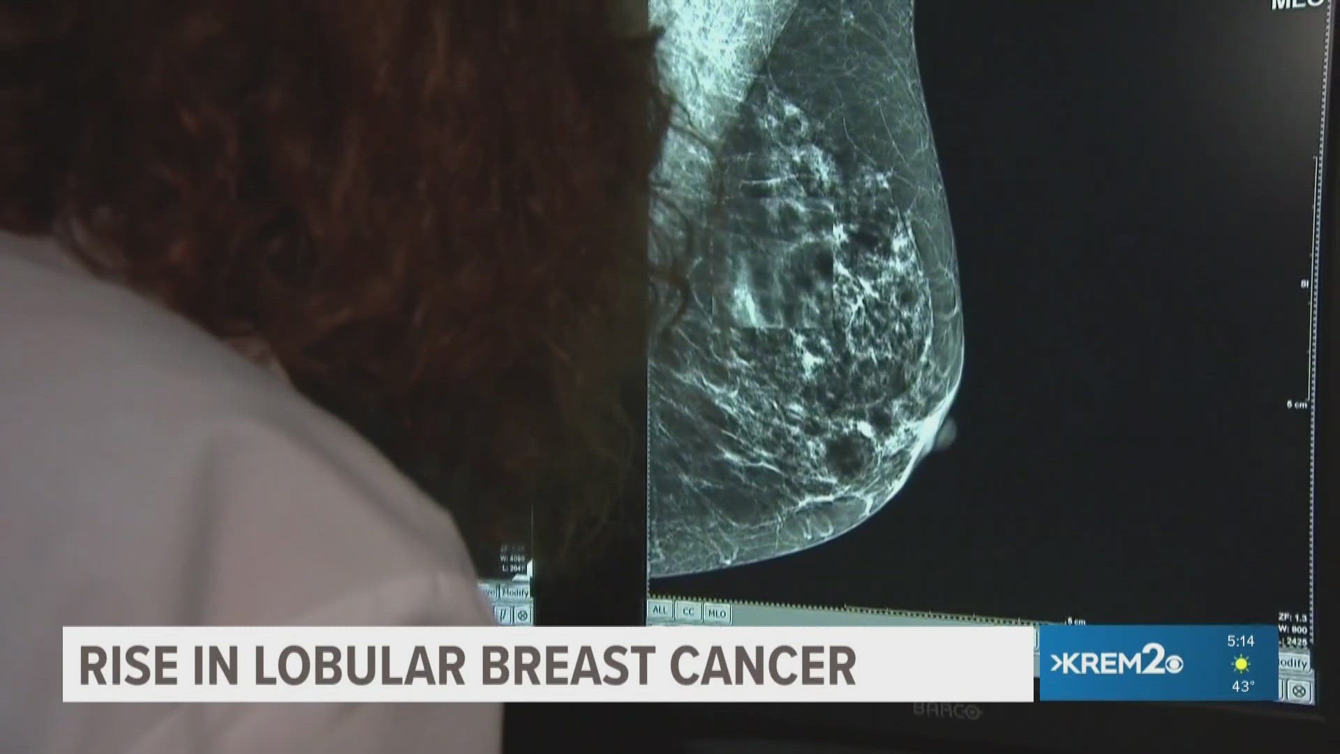 New report shows rise in lobular breast cancer