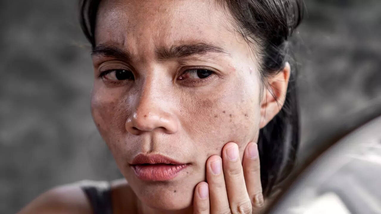 Dark spots on skin and its link with liver: 5 things to know