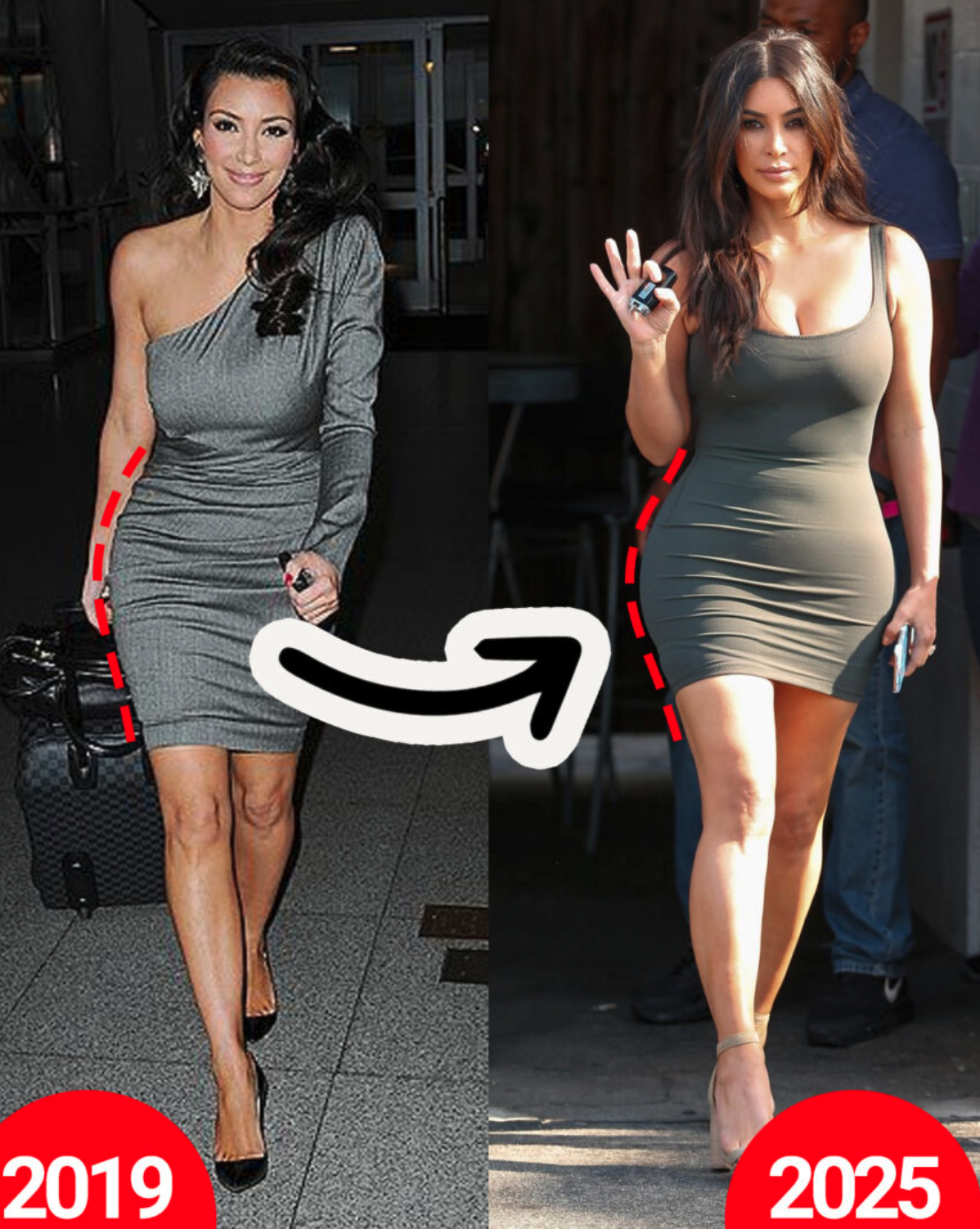 The BBL Boom: How Celebrities Sparked the Trend and Why Global Patients ...