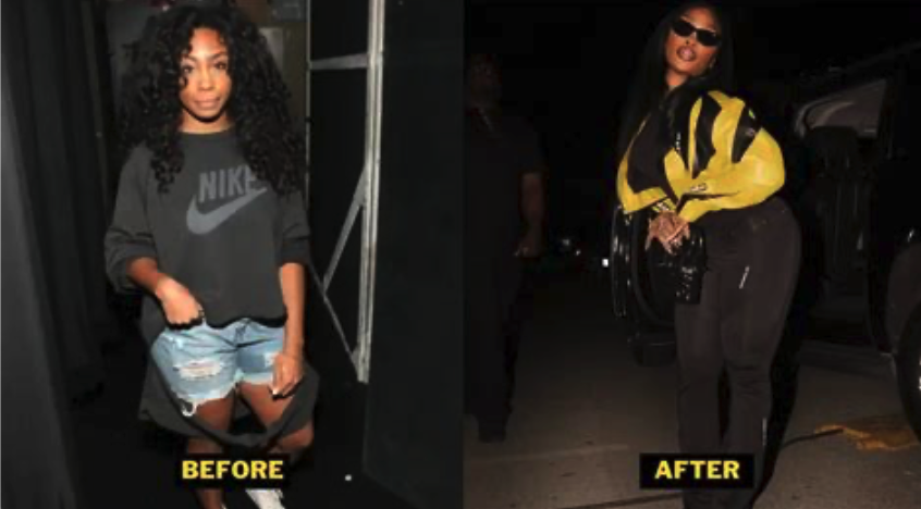 The BBL Boom: How Celebrities Sparked the Trend and Why Global Patients ...