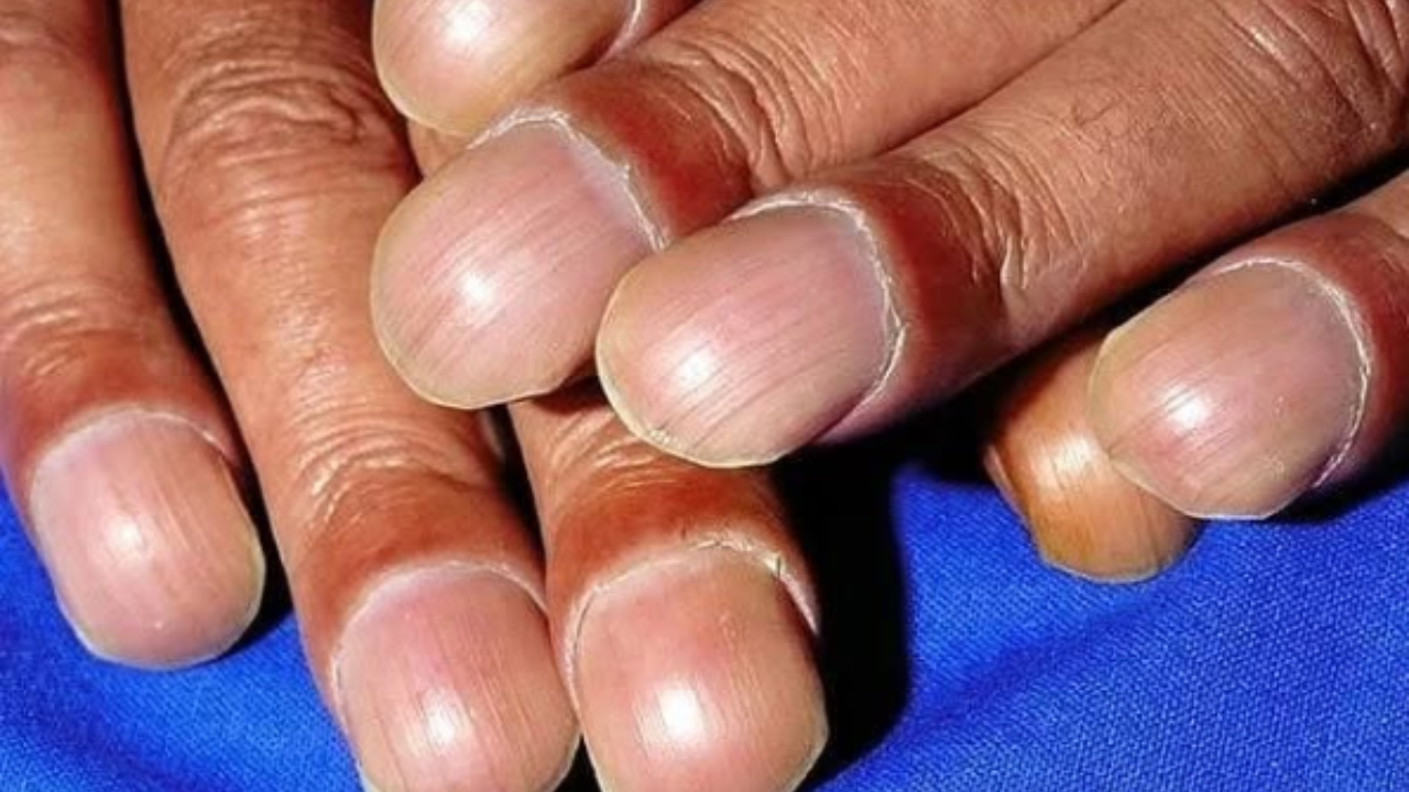 What is clubbing of nails, and why is it among the early indicators of ...