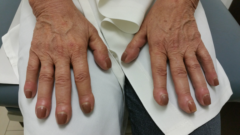 What is clubbing of nails, and why is it among the early indicators of ...
