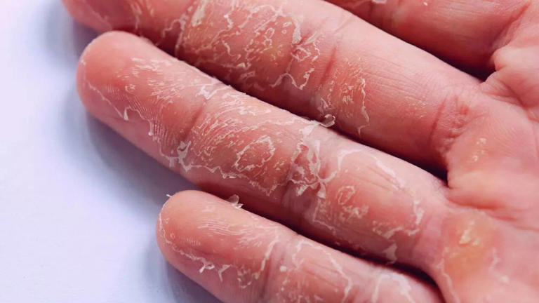 6 health issues behind dry, cracked fingertips and how to treat them