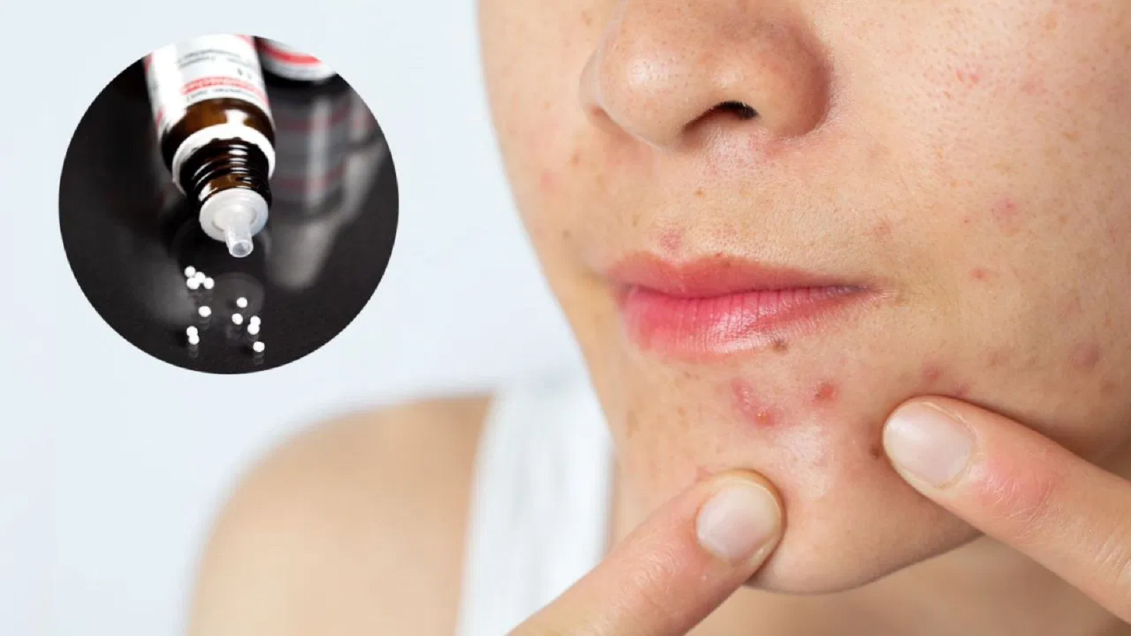 Homeopathy for Acne: A Natural Way to Heal Pimples and Restore Clear Skin