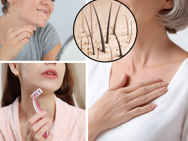 Huch, Haare an Brust, Kinn, Bauch: Hirsutismus in der Menopause