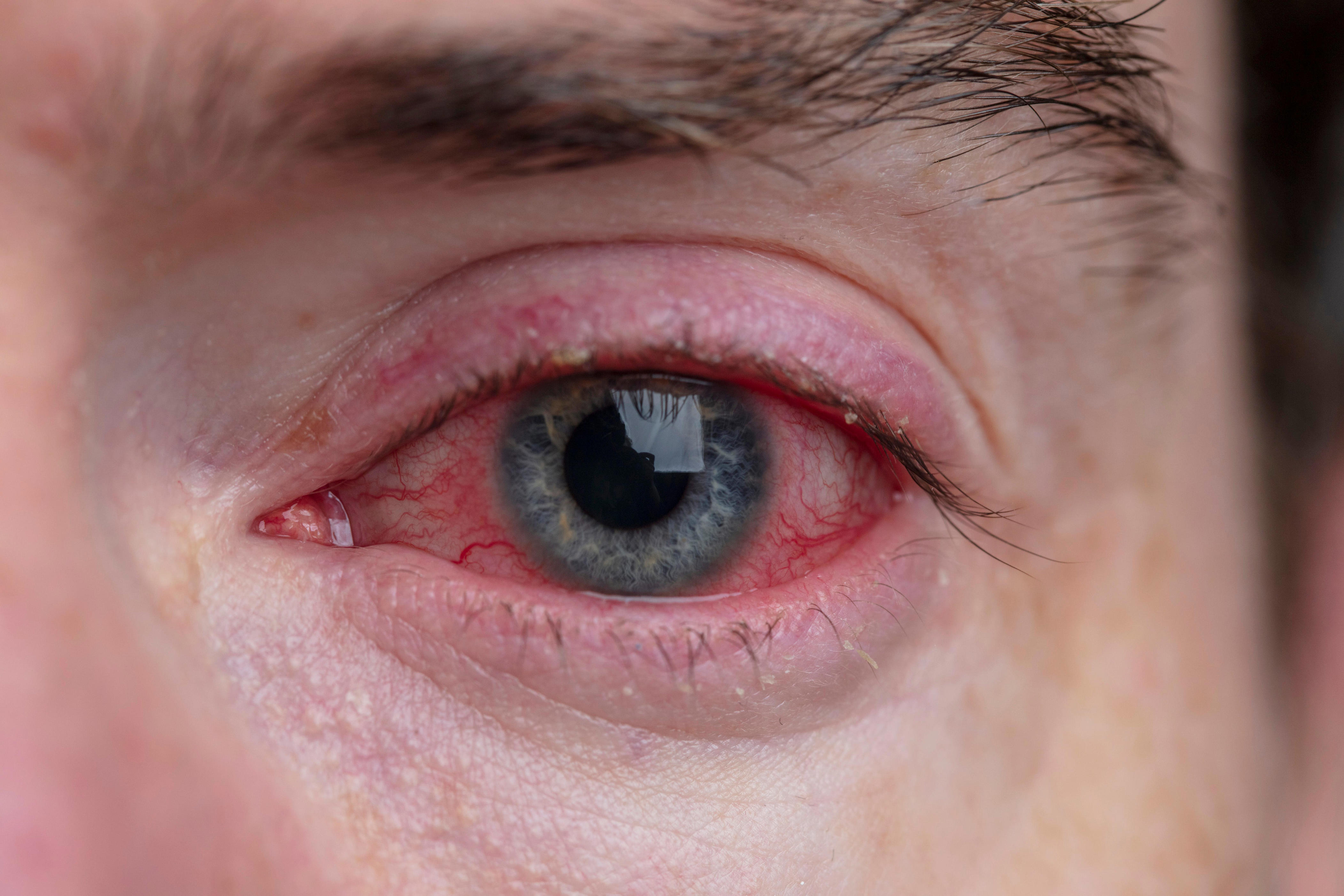 Doctors warn against trying 'unproven remedies' to cure pink eye